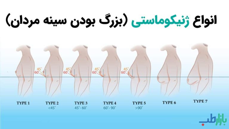 هفت نوع ژنیکوماستی (بزرگی سینه آقایان) و نحوه درمان | بازارطب